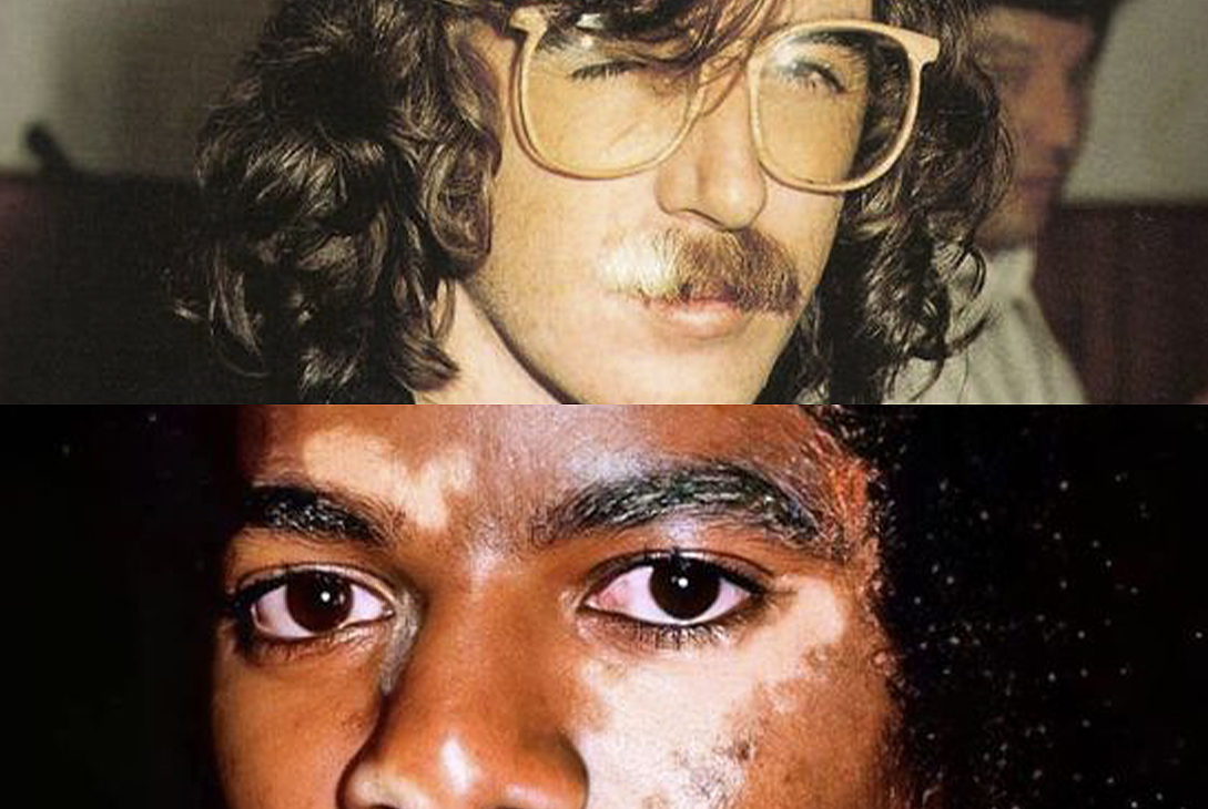 Comprehensive Vitiligo Care Program: Misiones Province Leading the Way ...